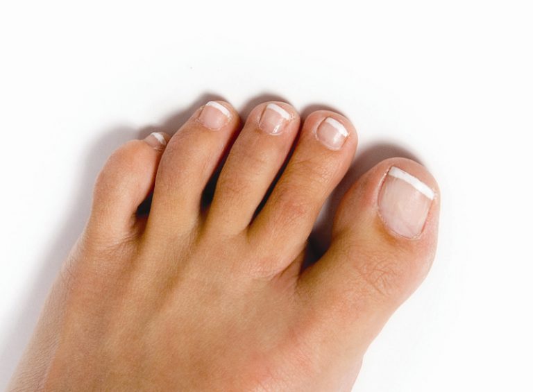 Symptoms of Toenail Fungus - Beauchamp Foot Care - Beauchamp Foot Care