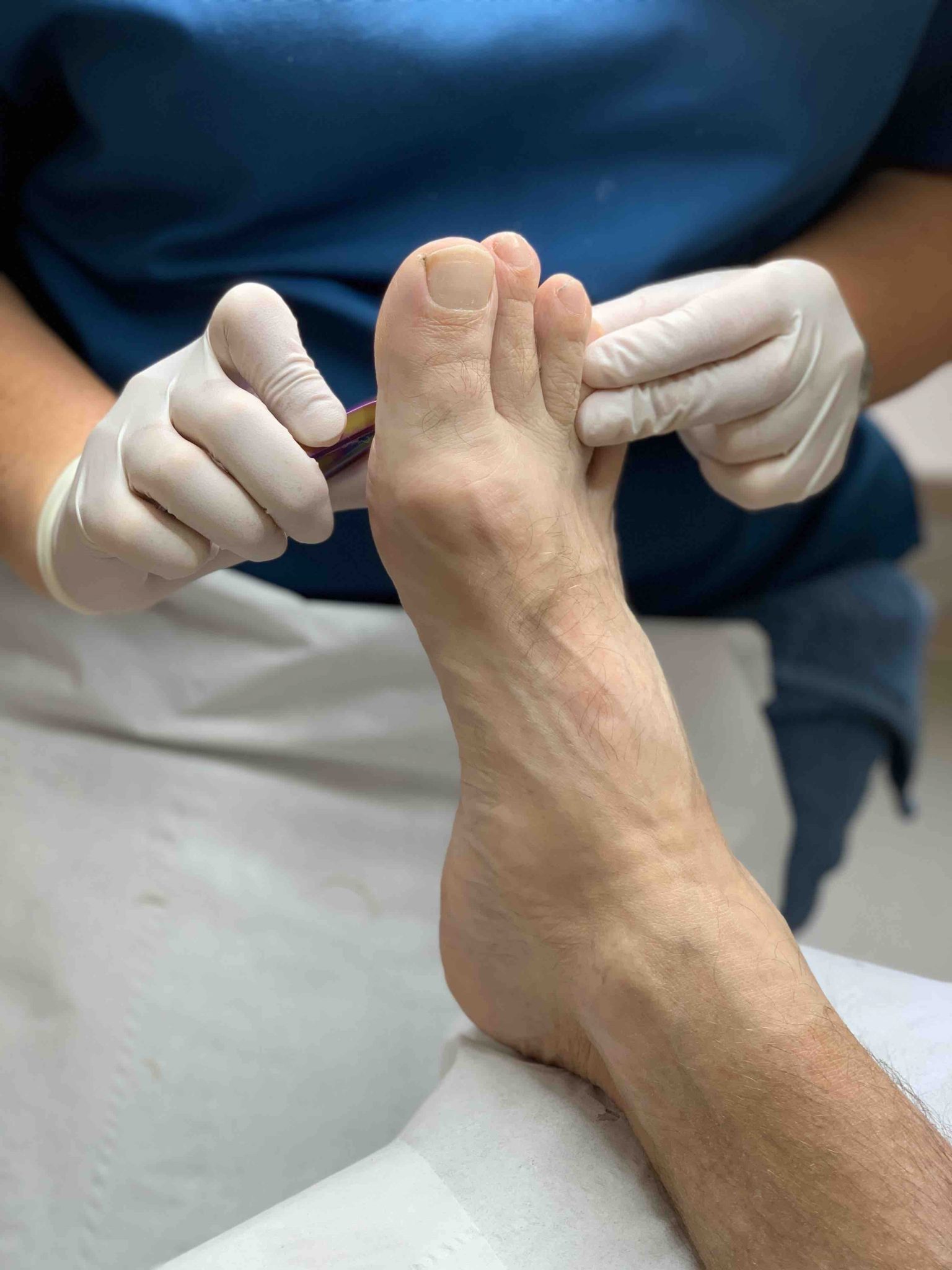 Verruca Removal - Beauchamp Foot Care - Beauchamp Foot Care