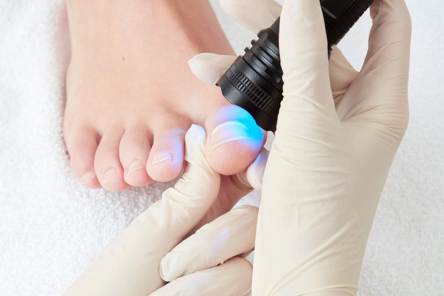 Onyfix nail correction - Beauchamp Foot Care - Beauchamp Foot Care